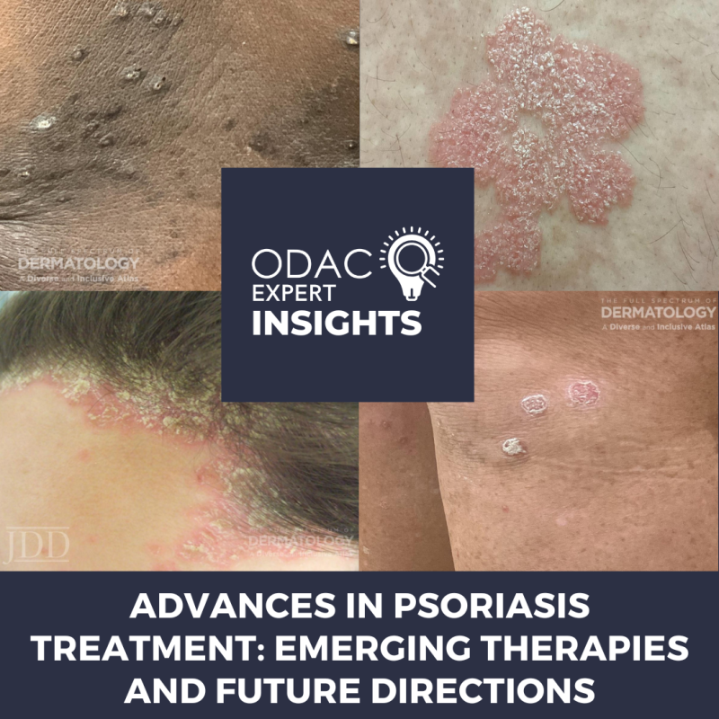 Emerging Therapies in Psoriasis: Highlights from ODAC Dermatology ...