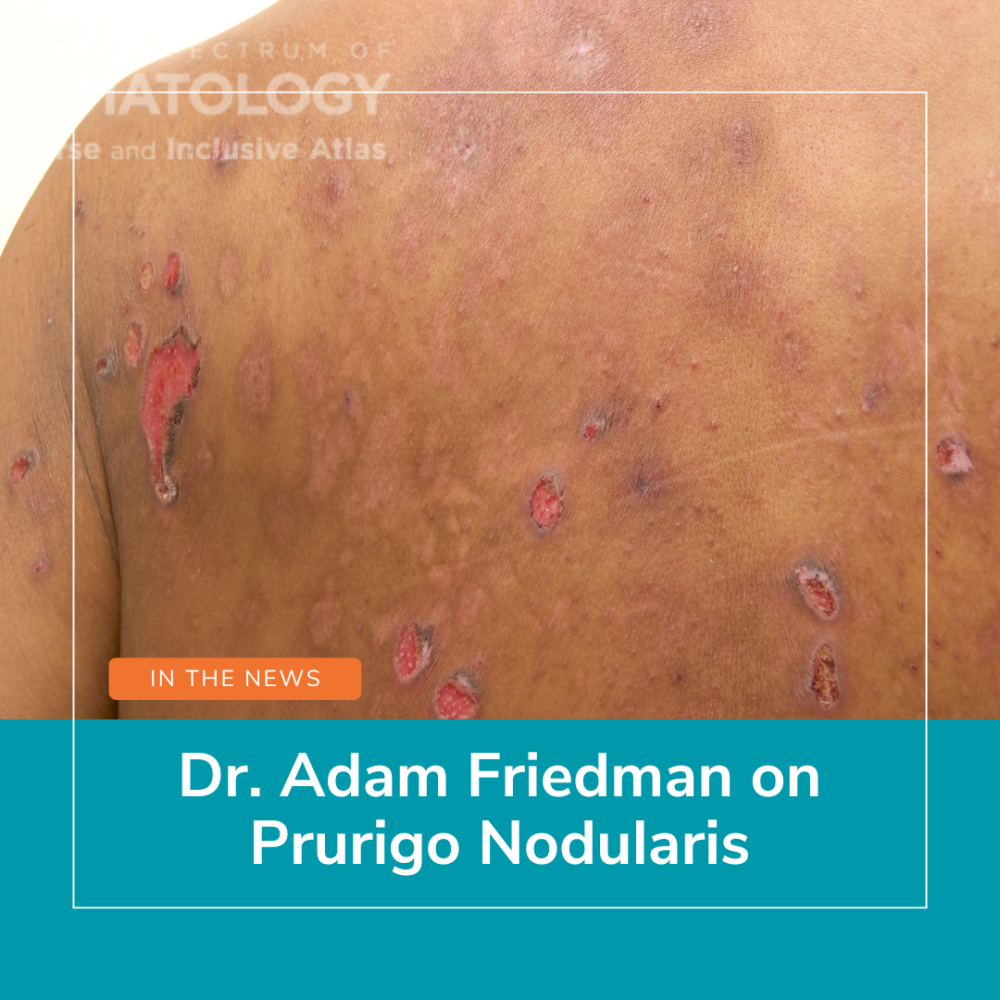 The Dermatology Digest: ODAC 2025 Coverage on Prurigo Nodularis | ODAC ...