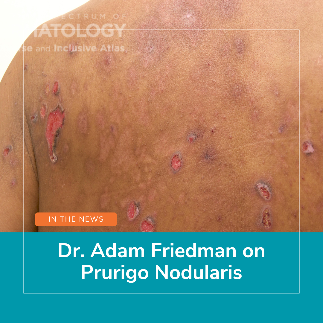 The Dermatology Digest: ODAC 2025 Coverage on Prurigo Nodularis | ODAC ...